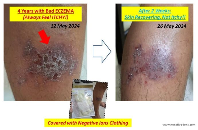Eczema Testimonials | Negative Ion Clothes